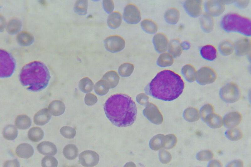 Medical Laboratory and Biomedical Science: PML-RARA for Promyelocytic ...