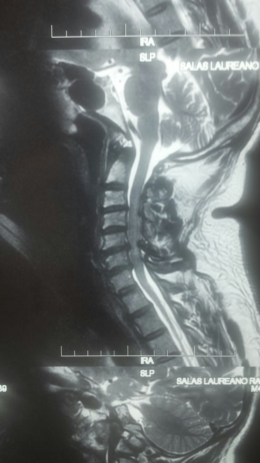 Columna vertebral degenerativa: Estudios complementarios Resonancia ...