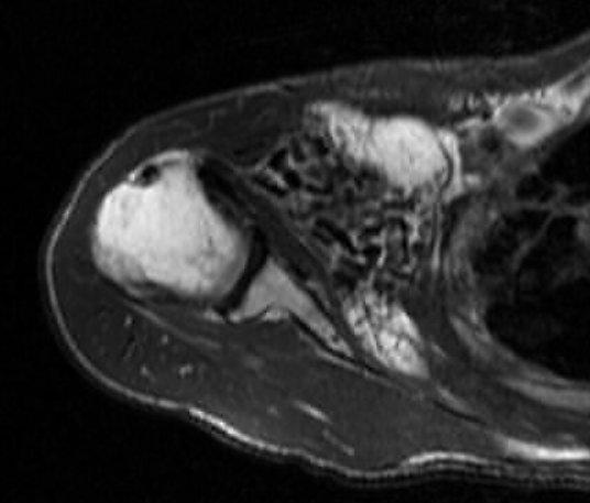 Synovial chondromatosis -MRI - Sumer's Radiology Blog