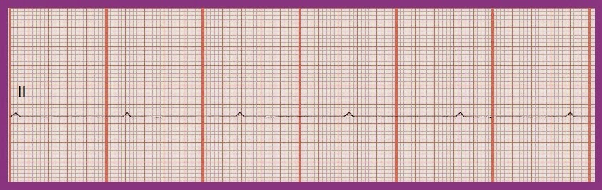 Practice EKG Rhythm Strips 219
