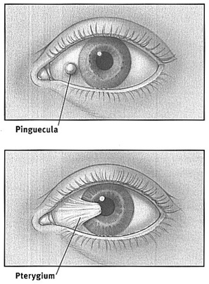 Dawn: Pterygium vs Pinguecula