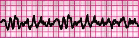 Ventricular Fibrillation