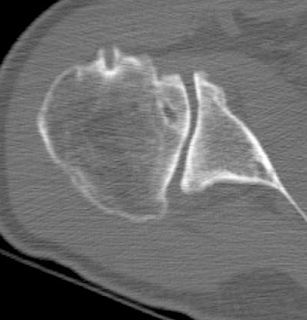 Shoulder Arthritis / Rotator Cuff Tears / Shoulder Pain : Why do ...