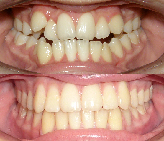 The Blog of Drs. Simon, Haerian, & Ludwig: Open Bite? Case Closed!