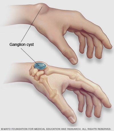 Tom's Physiotherapy Blog: Fingers: Ganglion Cysts