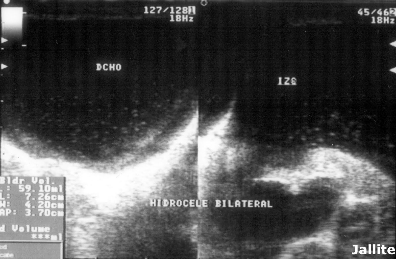 Hidrocele Bilateral & Hidatide Morgagni