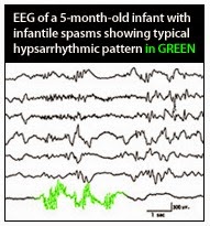 Team Bex: About West Syndrome