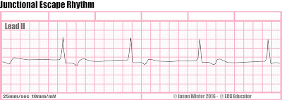ECG Educator Blog : Six Second ECG Rhythm Strips