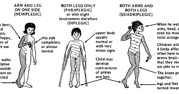 Physical Therapy DataBase: Cerebral Palsy - Part II