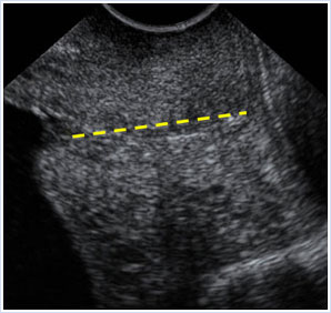BLOgOEAS: Prevención del parto pretérmino