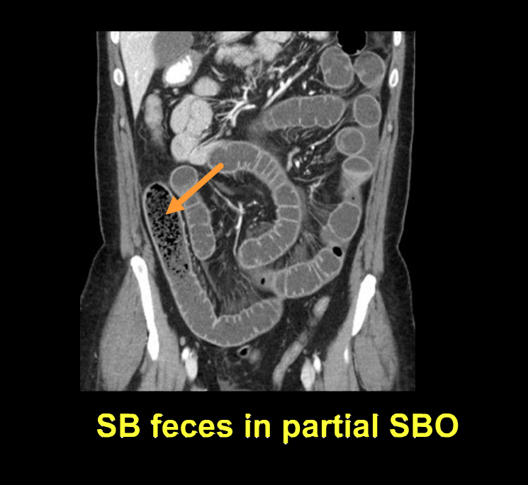 rsna: small bowel obstruction