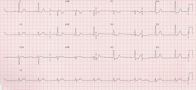 Posterior ST Elevation Myocardial Infarction | INA - ECG