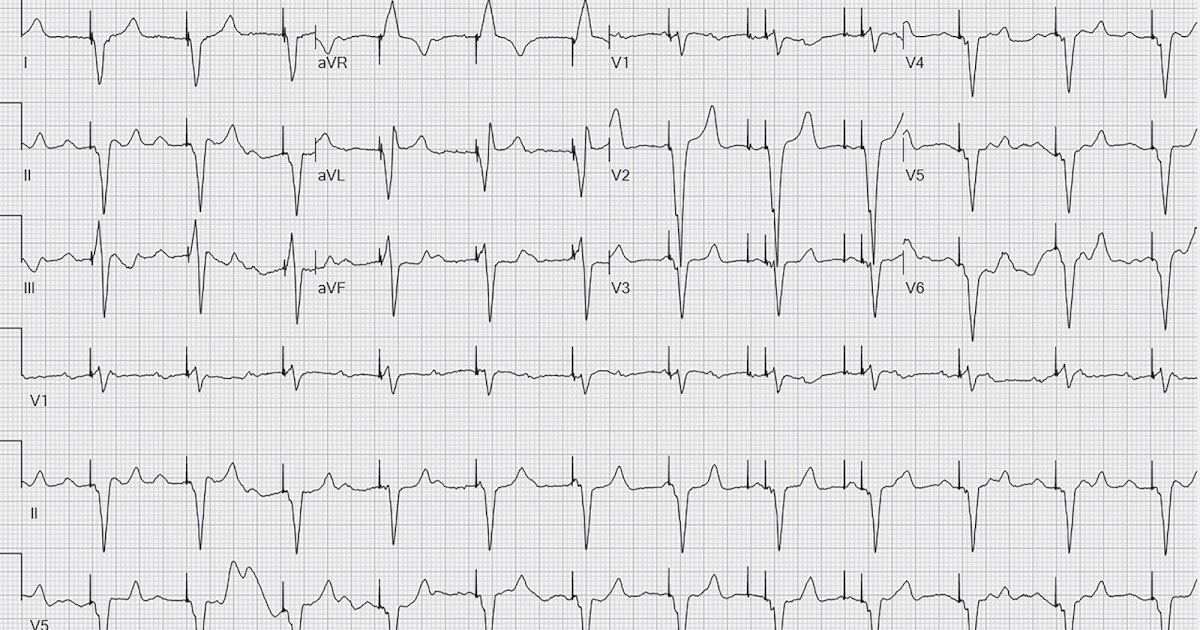 Focus on ECGs: Case #11 — Is the Pacemaker Functioning Properly?