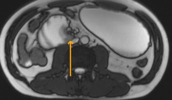 mricases: Intestinal malrotation with duodenal obstruction secondary to ...