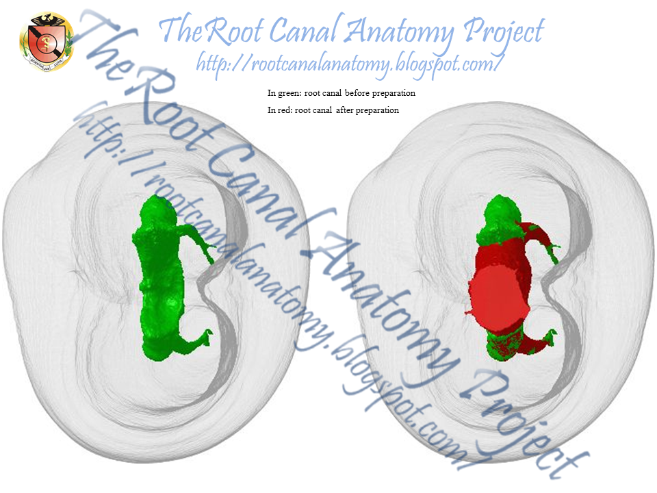 The Root Canal Anatomy Project: Conservative Endodontic Access ...
