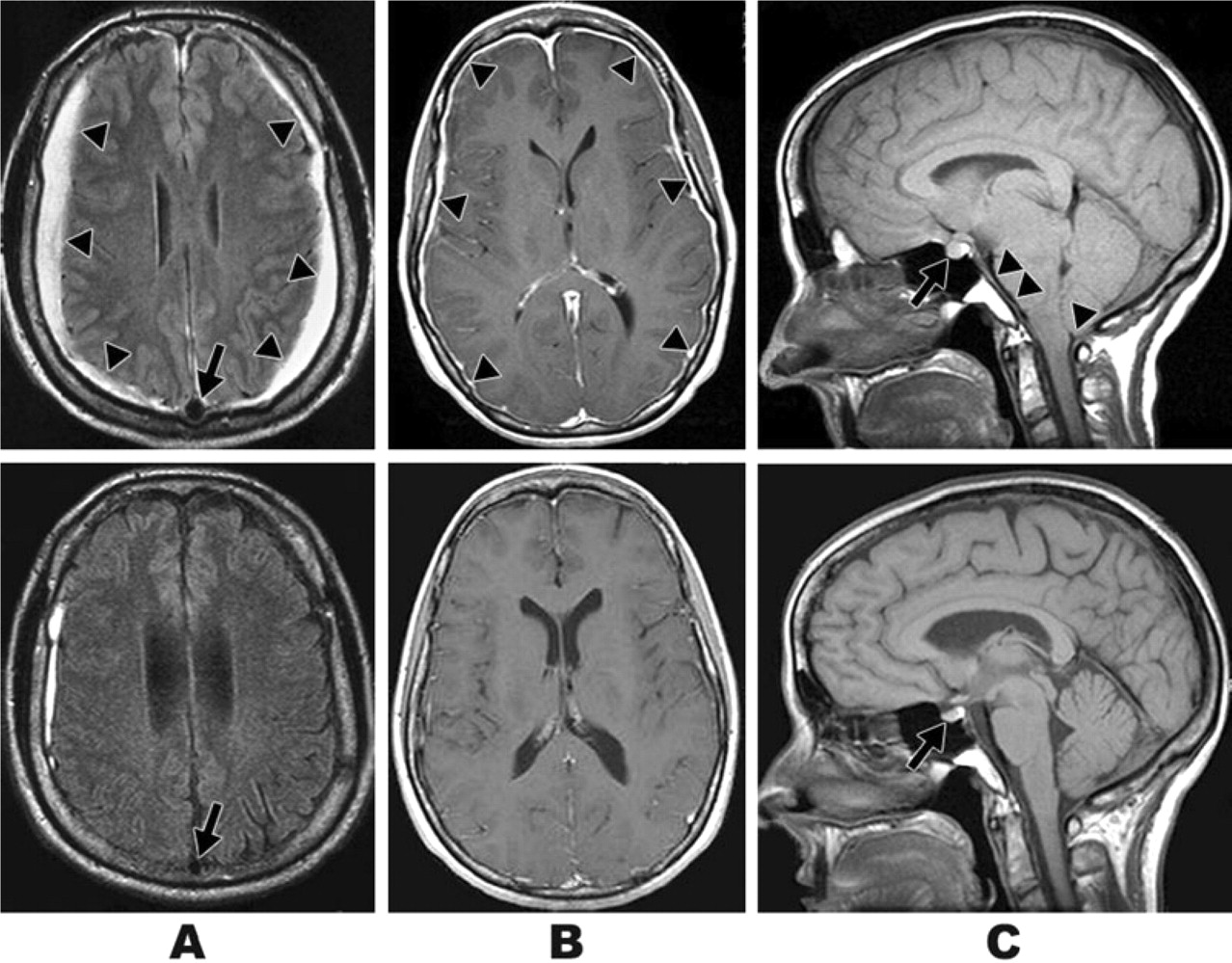 Image Bank: MRI features of CSF Hypotension