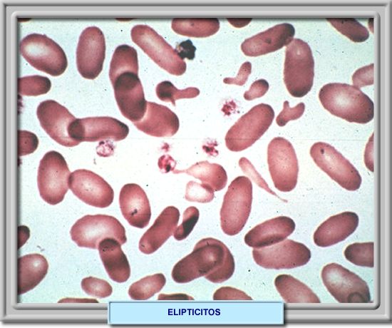 Fichero: Anormalidades Morfológicas Eritrocitarias