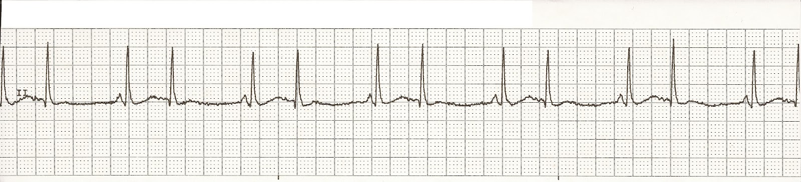 EKG Rhythm Strips: Atrial Rhythms