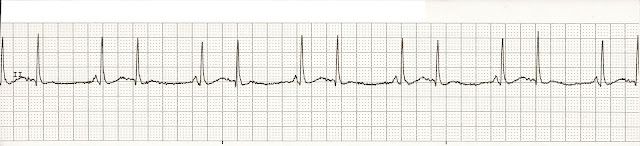 EKG Rhythm Strips: Atrial Rhythms