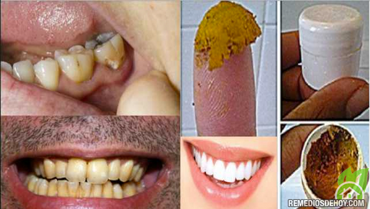 CURA LA CARIES, ENFERMEDAD DE LAS ENCÍAS Y BLANQUEA LOS DIENTES USANDO ... CURA LA CARIES, ENFERMEDAD DE LAS ENCÍAS Y BLANQUEA LOS DIENTES USANDO ...