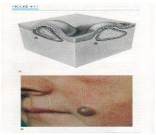 Nurul aida wahidah: penyakit kelainan pada kulit