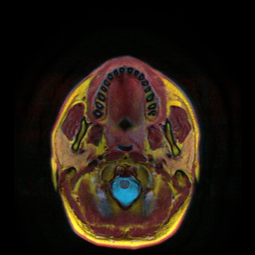 Nevit's blog: Color MRI of the Neck