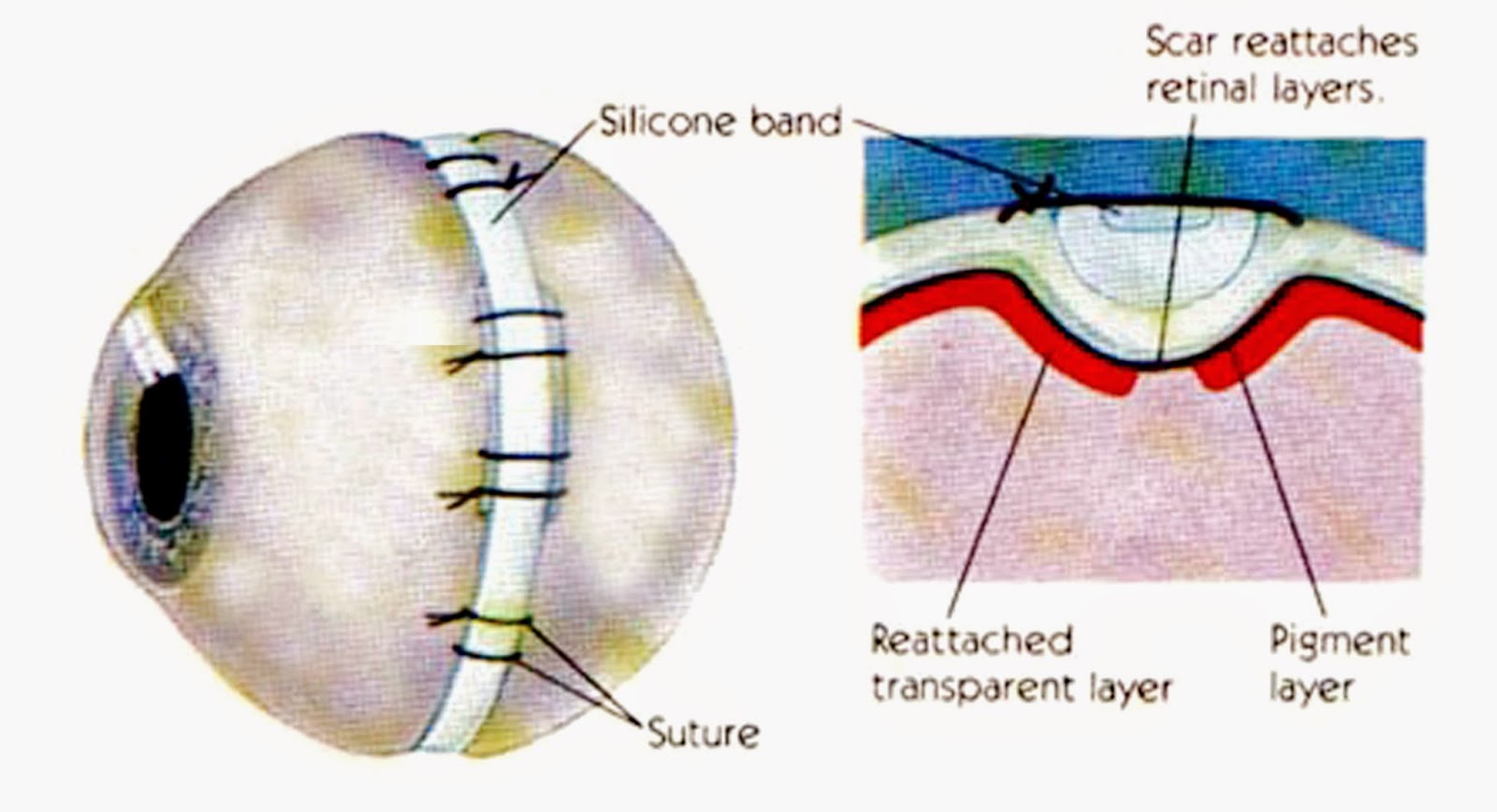 EYE PROBLEMS: Myopia,Retinal Breaks,Retinal Detachment