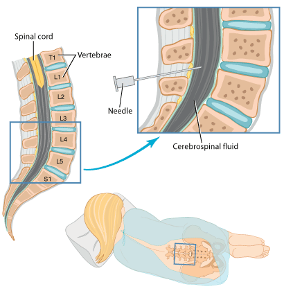 Children's Health: Lumbar Puncture (Spinal Tap) | Child Healthy