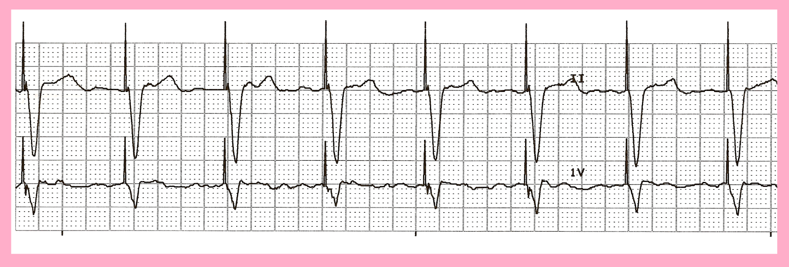 Practice Rhythm Strips 281