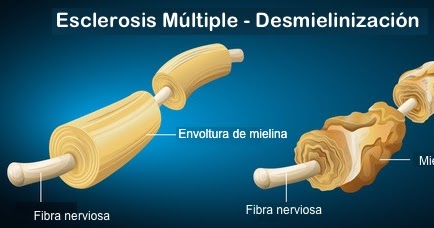 Blog de ortopedia Inse: LA ESCLEROSIS MÚLTIPLE (EM) (Parte 1)