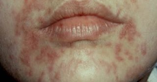 Maladie de Dermite séborrhéique | Maladies de Peau