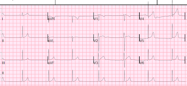 Dr. Smith's ECG Blog: Chest Tightness and Asthma in a Young Man