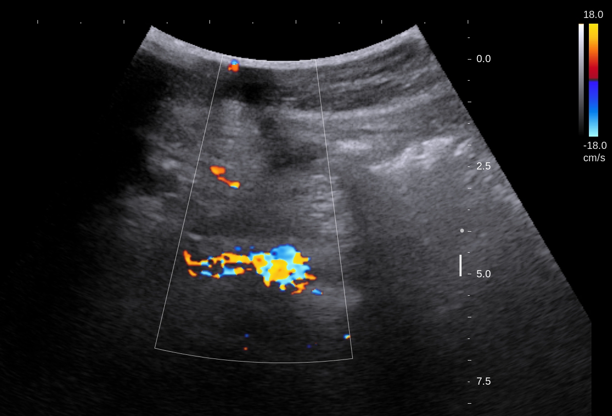 VIETNAMESE MEDIC ULTRASOUND: CASE 426: MULTIPLE TUBERCULOSIS ABSCESSES ...
