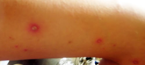 Tips Para Sa May Bulutong (Chicken Pox)