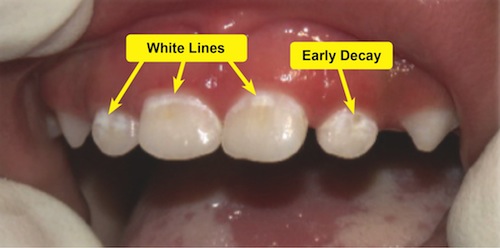 Pediatric Dentist, Bangalore: Process of Dental Caries in Children