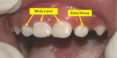 Pediatric Dentist, Bangalore: Process of Dental Caries in Children