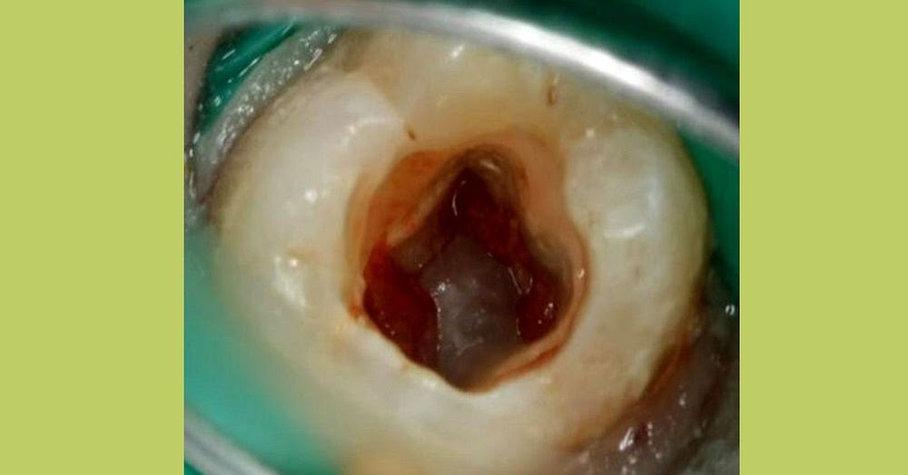 PEDIATRIC DENTISTRY : Pulp therapy and primary tooth pulpotomy - odontobebe