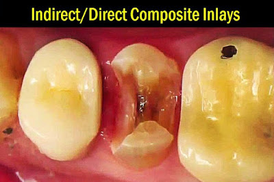 OPERATIVE DENTISTRY: Indirect/Direct Composite Inlays - Odonto-Tv