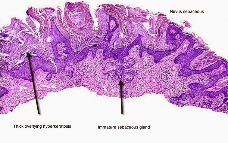 Dermpath Made Simple - Neoplastic: Sebaceous Tumours