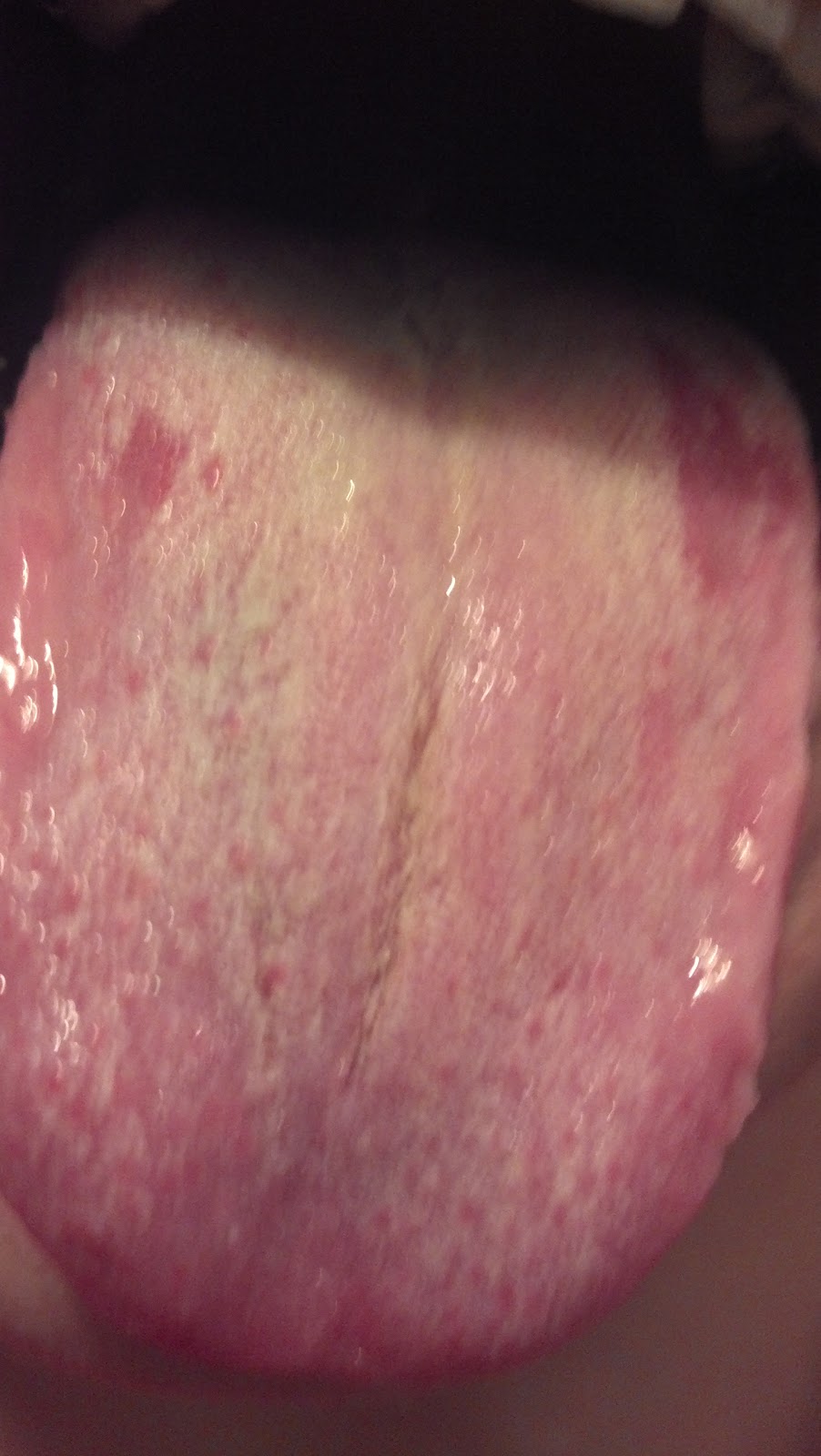 Spots On Tongue Causes And When To See A Doctor Ed8