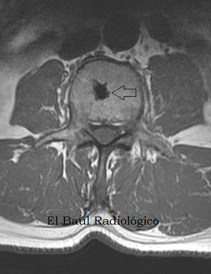 El Baúl Radiológico: ENOSTOSIS: ISLOTE ÓSEO (Bone Island: CT and MRI ...