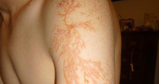 Lightning Flower Scars