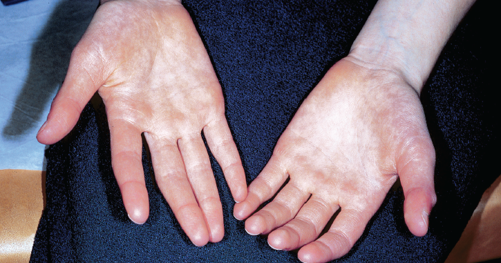 Acrocyanosis ICD-10, Definition, Pictures, Symptoms, Causes, Treatment ...