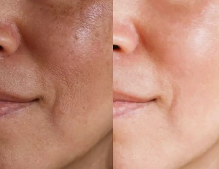 Best Proven Remedies to Reduce and Shrink Skin Pores - Health Recipes ...