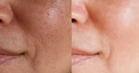 Best Proven Remedies to Reduce and Shrink Skin Pores - Health Recipes ...