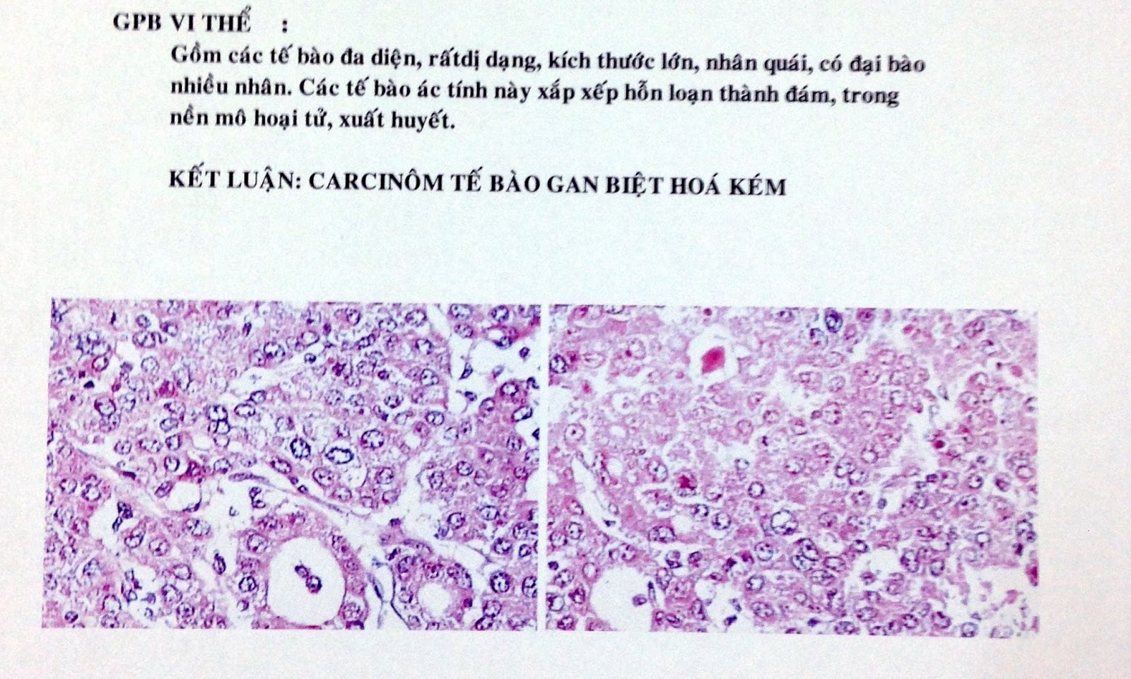 VIETNAMESE MEDIC ULTRASOUND: CASE 390: PEDUNCULATED HCC, Dr PHAN THANH ...