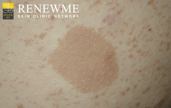 Renewme Skin Clinic: Why Birthmark at Renewme?