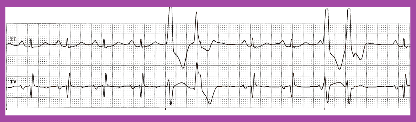 EKG Rhythm Quiz 274