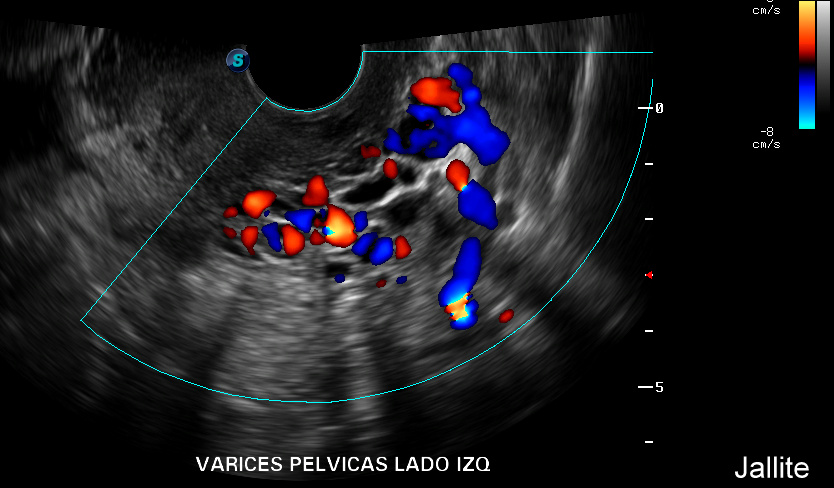 Varices Pelvicas en Paciente con Útero Bicorne