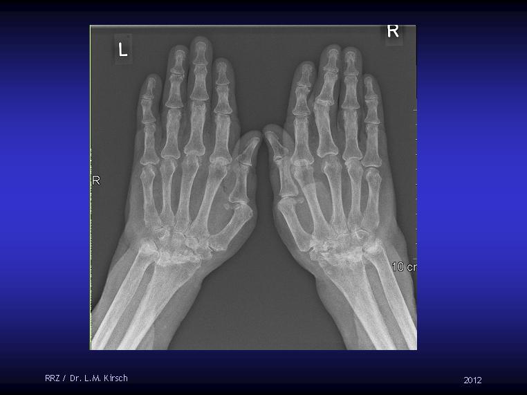 Rheumatologe: Rheumatoide Arthritis - Alte und neue DMARDs - EULAR und ...